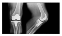 Knee Extension After A Total Knee Arthroplasty (TKA)